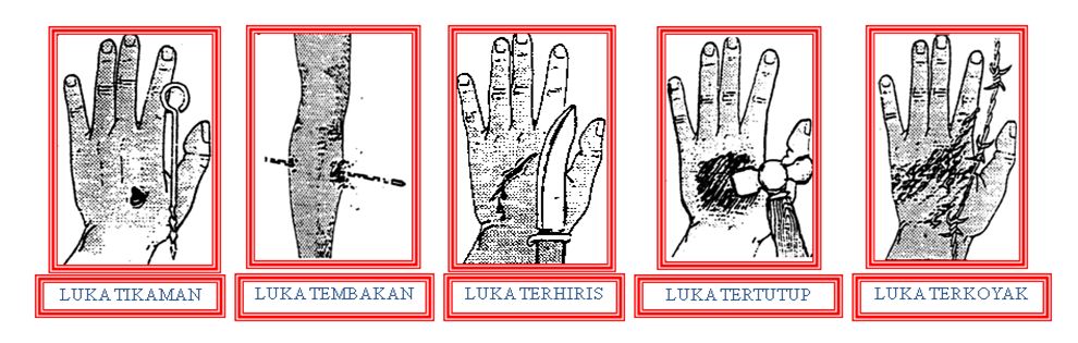 FIRST AID : LUKA ( WOUND ) ( BASIC )