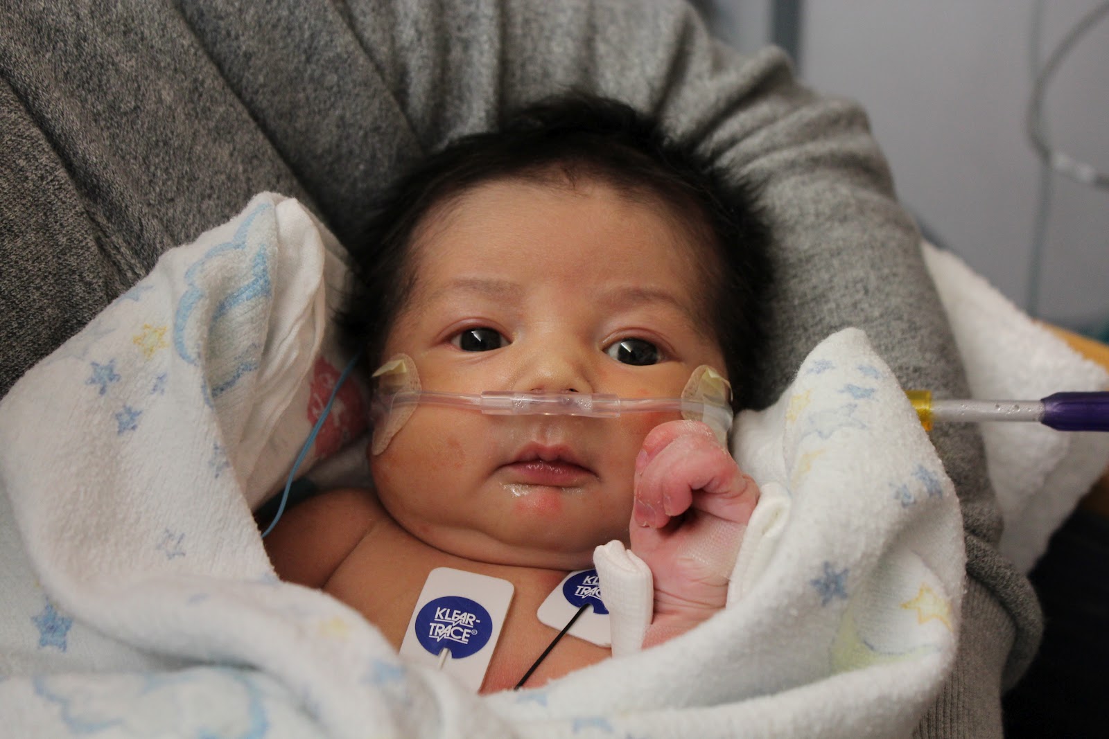 Baby Luna's CDH Story: Extubated!!!