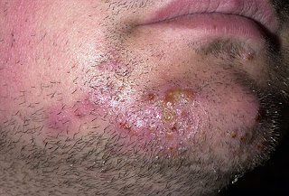 relationadvisor: Beard Rash: Causes, Symptoms, Treatment & Prevention Tips
