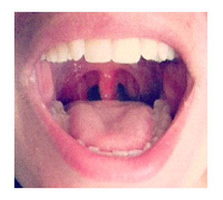 Swollen (Enlarged) Uvula – Causes, Symptoms, Treatment, Home Remedies