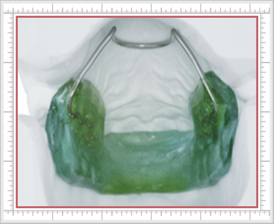 Функционални ортодонтски апарати ~ Медико-техническа ортодонтска ...