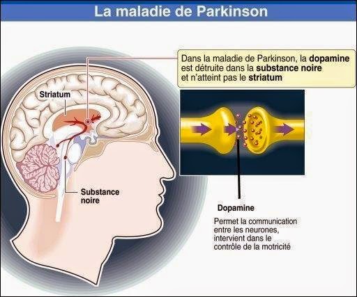 La maladie de Parkinson | Récap' IDE