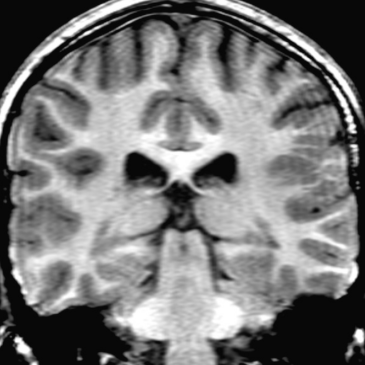 Polymicrogyria-Mayo Radiology