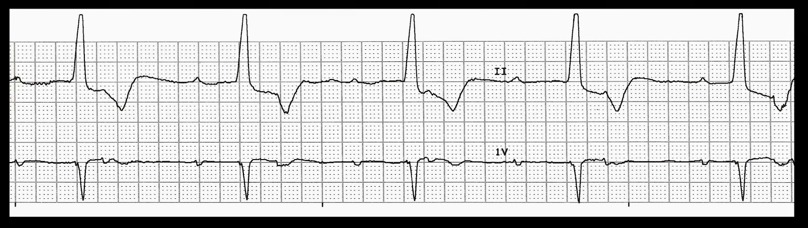 Various Third Degree Heart Blocks