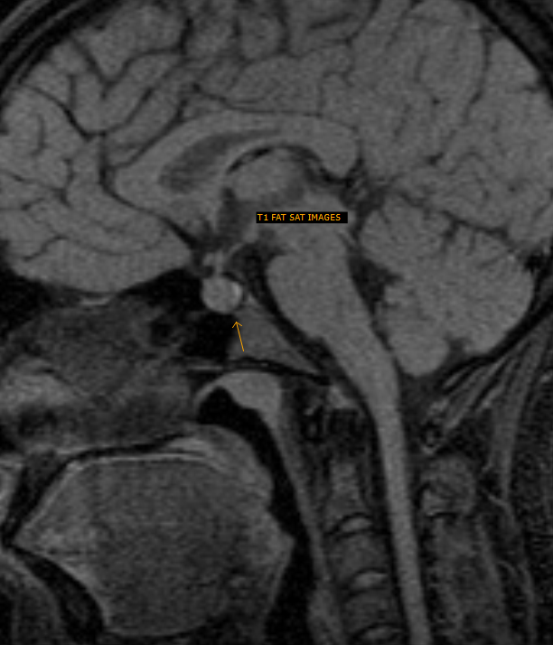 Rathke's Cleft Cyst-MRI - Sumer's Radiology Blog