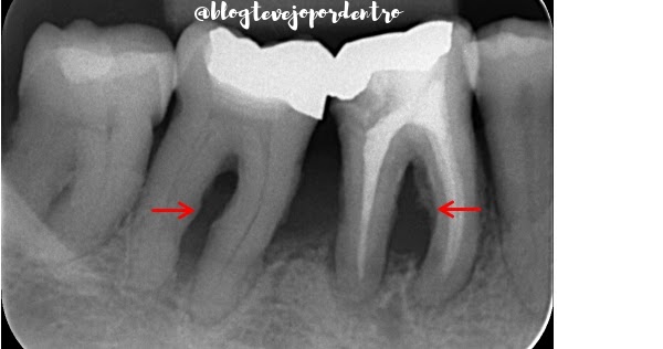 "Te vejo por dentro": Lesão de furca