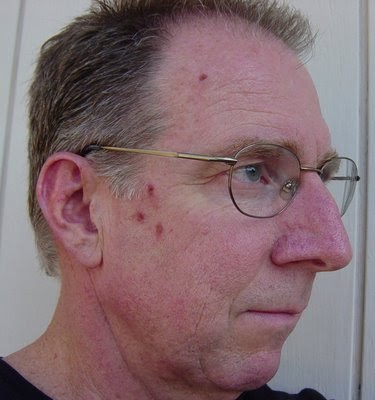 Kenneth Cua: Facial Blemishes (Before & After)