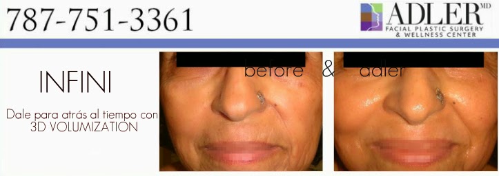 Infini: Rejuvenecer el rostro sin cirugía en Adler Facial ...
