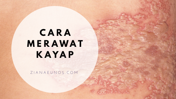 Cara Merawat Kayap dengan Lebih Berkesan dan Selamat | Suplemen Shaklee ...