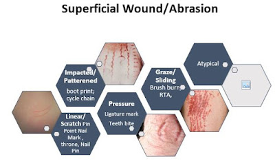 My notes: Its How I graduated Medical School.: Types of Wound ...
