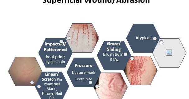 My notes: Its How I graduated Medical School.: Types of Wound ...