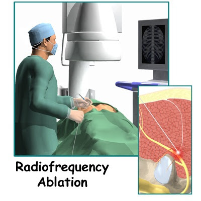 Advanced Pain Centers Pakistan: Radio Frequency Ablation