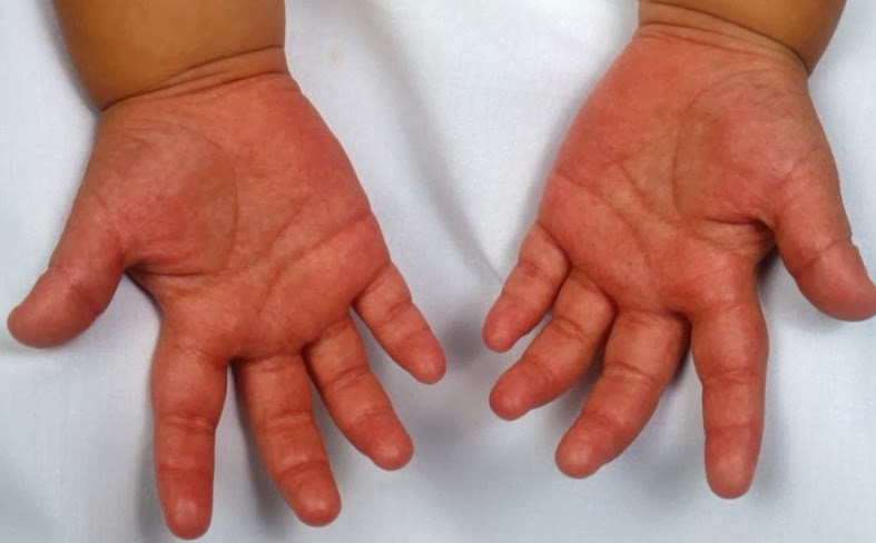 Medical Treatment Pictures-for Better Understanding: Kawasaki Disease