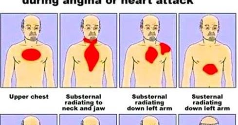 Angina Pektoris ~ Informasi Kedokteran Dan Kesehatan