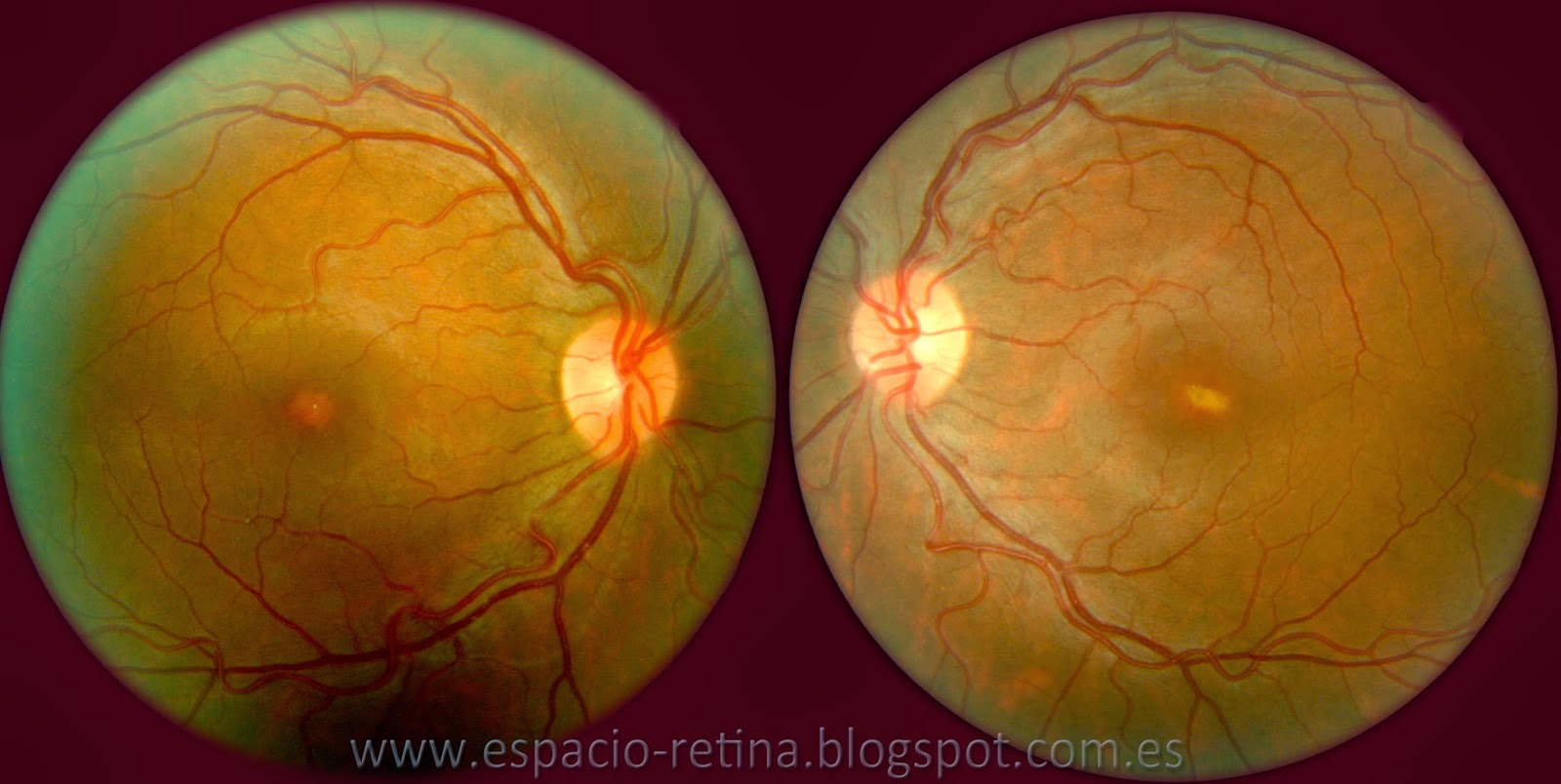 ESPACIO RETINA: Distrofia Viteliforme Foveomacular del adulto.