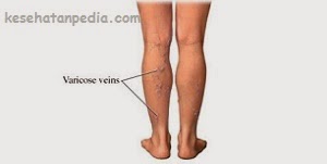 Cara Mencegah Varises Selama Masa Kehamilan - kesehatanpedia