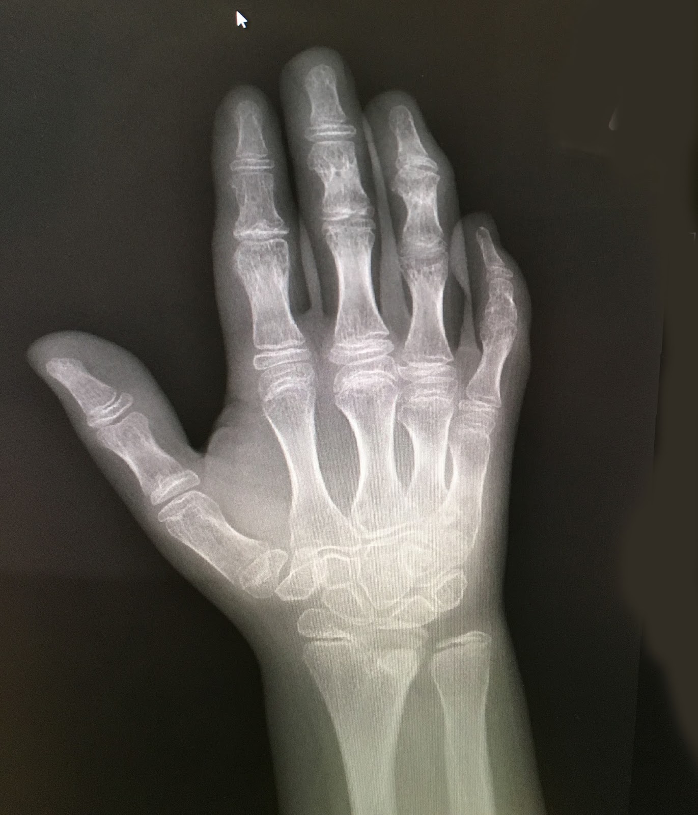 The Hand in Multiple Epiphyseal Dysplasia | Congenital Hand and Arm ...