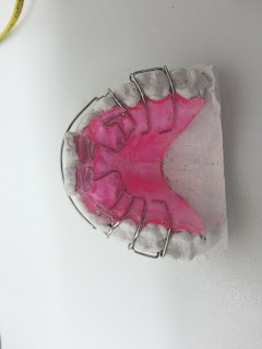 Ortobella: Aparelhos de expansão com arco de hawley.(batente anterior ...