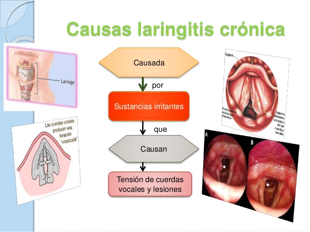 microbiologíaKTMD: Laringitis