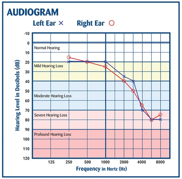 Menieres Disease Audiogram