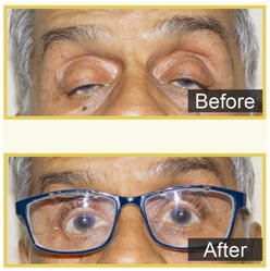 PTOSIS CRUTCH GLASSESS