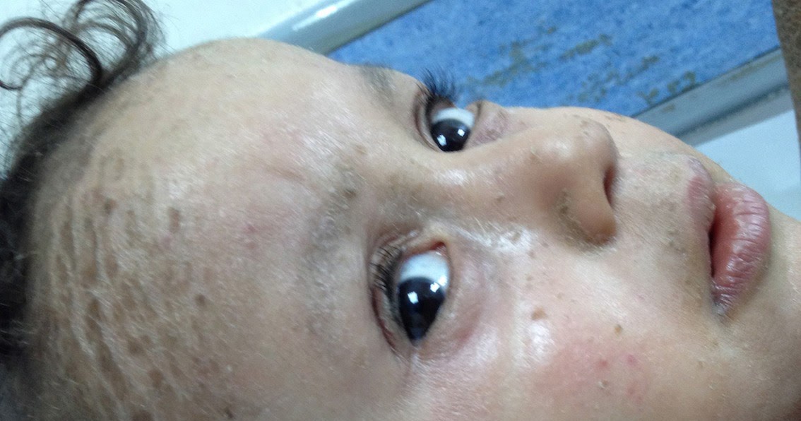 VIRTUAL GRAND ROUNDS IN DERMATOLOGY 2.0: Congenital Ichthyosis in an ...