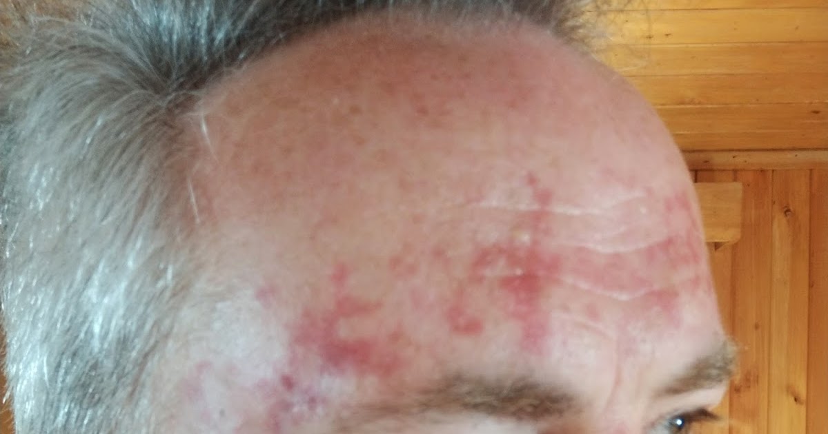 So let's see how this goes...Efudex/Efudix