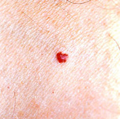Strawberry and Peach Ano 4: Angiomas ou Nevos rubis: o que são?