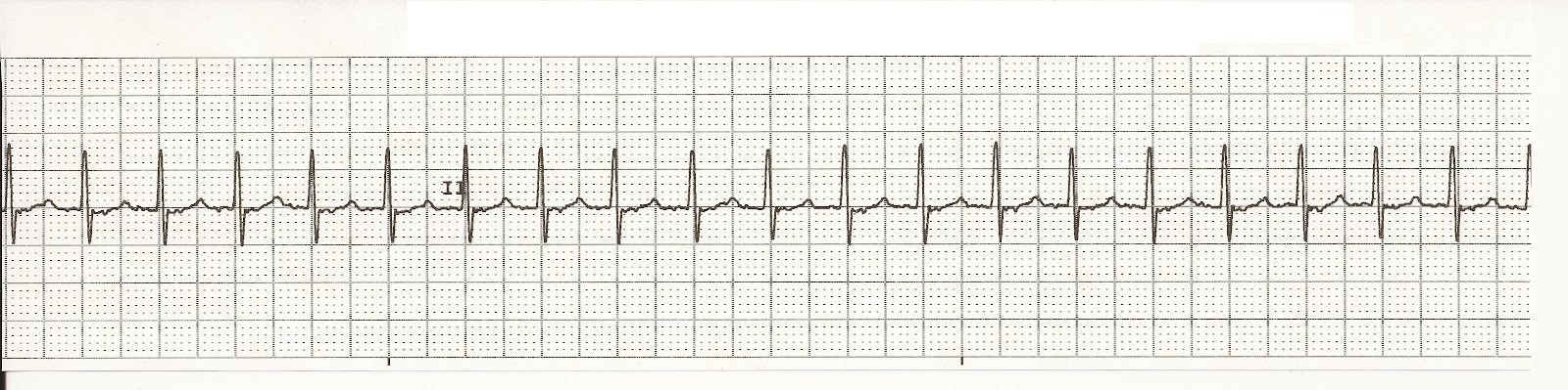 EKG Rhythm Strips: Atrial Rhythms