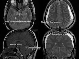 Dr Balaji Anvekar FRCR: Intracranial hypotension MRI