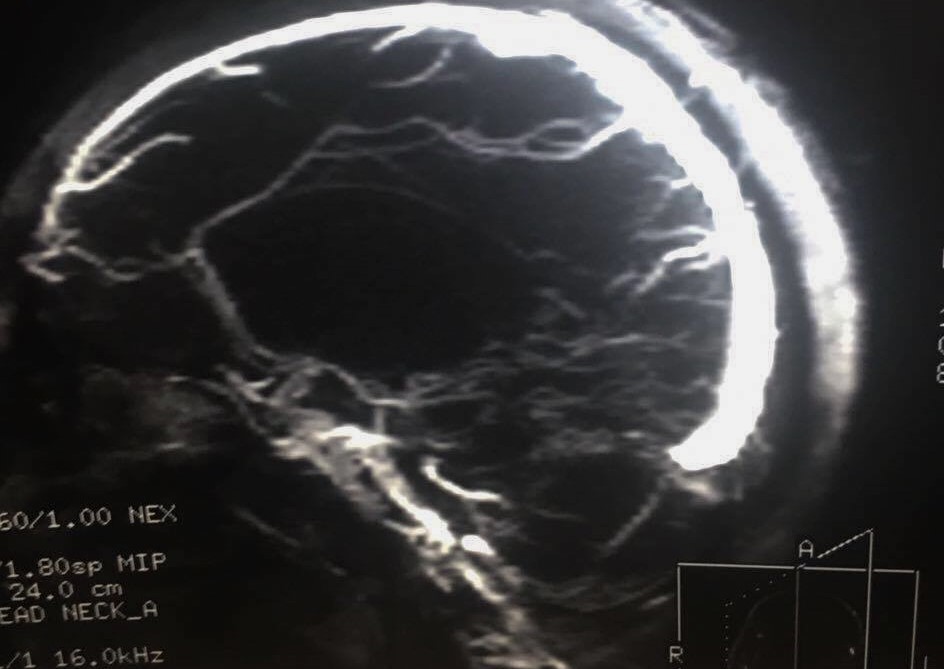 Deep cerebral Venous Thrombosis-MRI - Sumer's Radiology Blog