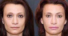 Fill Out And Expand Sunken Cheeks With Facial Aerobics Exercises ...