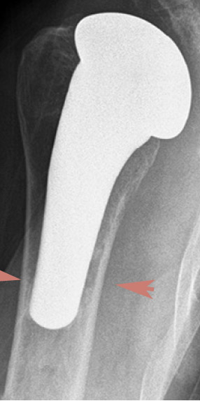 Short-stem humeral components, an advantage?