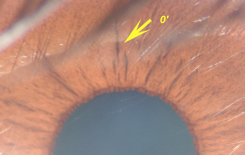 Modern & Multidimensional Iridology: Radial Furrow at @ 0' - Birth ...
