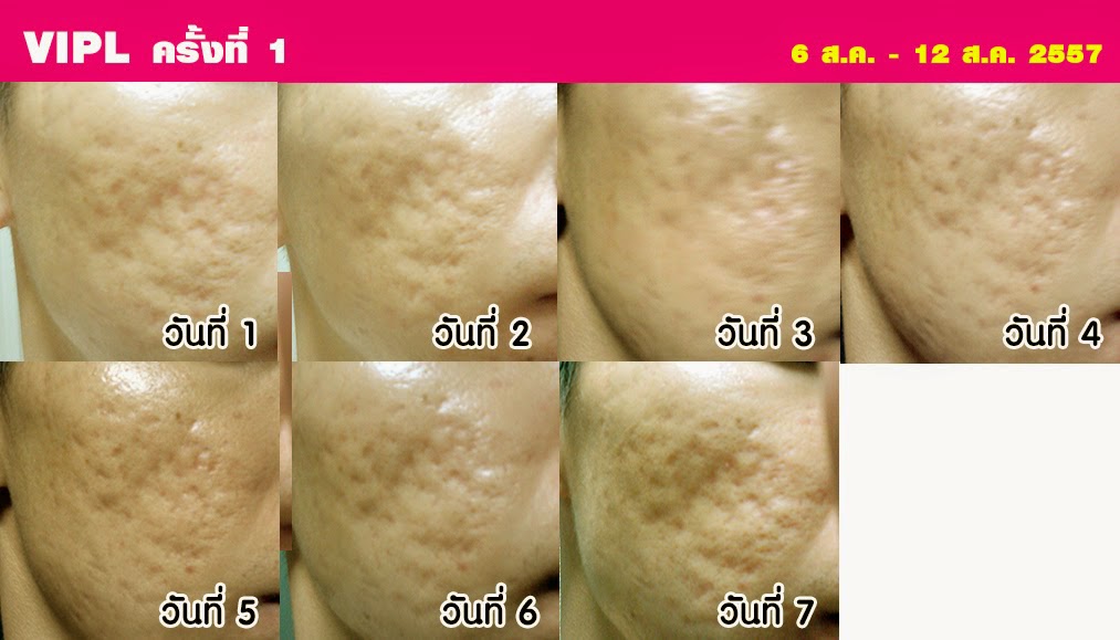 Review ทำ Mini subcision + VIPL ที่นิติพลคลินิก คราวนี้ทำ VIPL เป็น ...