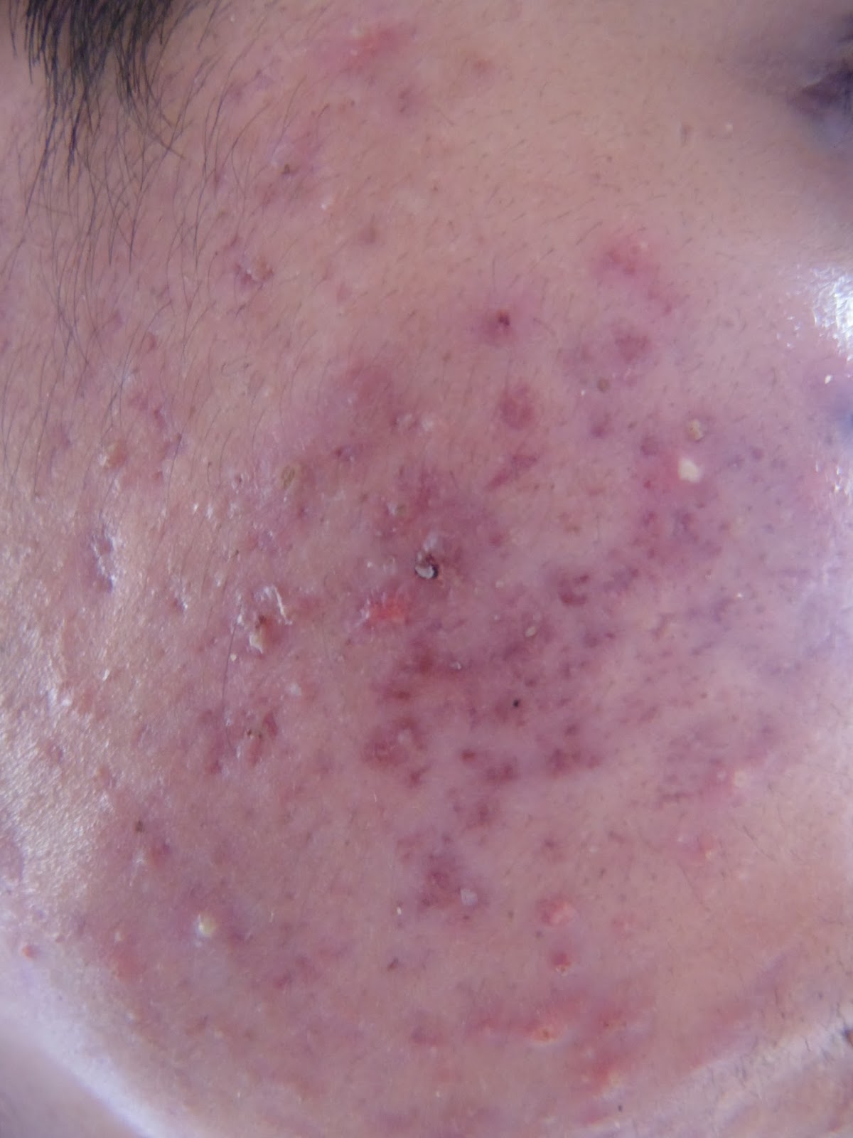 Retorno ao Dermatologista e Inicio do Tratamento com Roacutan ...
