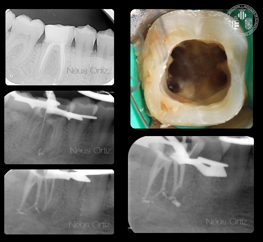 Máster en Odontología Restauradora y Endodoncia: Reendodoncia de Radix ...
