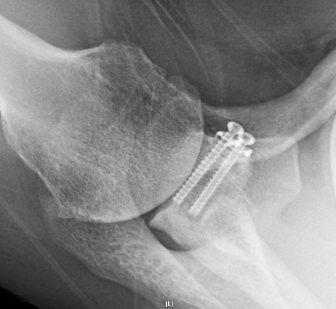 Shoulder Arthritis / Rotator Cuff Tears / Shoulder Pain : Latarjet - a ...