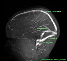 Dr Balaji Anvekar FRCR: Normal MR Venogram of brain