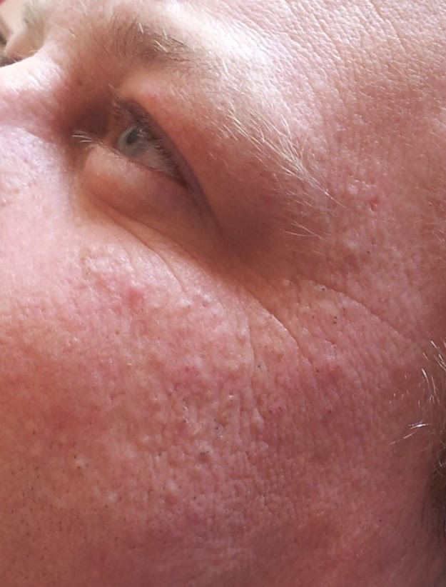 So life begins at 40 does it?: Environ Skin Peel - For Men!