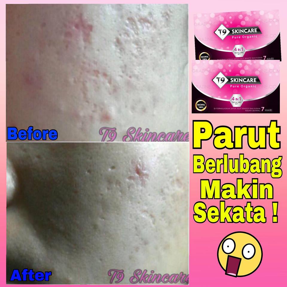 T9 SKINCARE: SERUM HILANG PARUT BERLUBANG & PARUT HITAM DENGAN BERKESAN