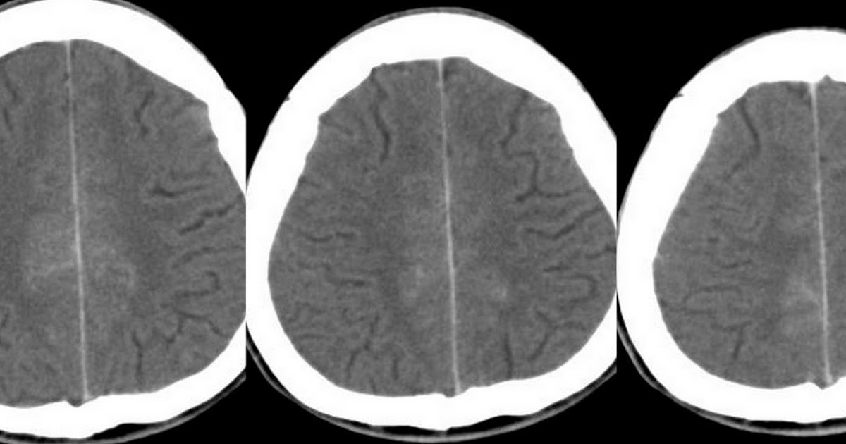 Dr Balaji Anvekar FRCR: Leptomeningeal Enhancement