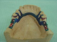 Protese Dentária: PPR - Passo a Passo - Onde chegaremos!!!