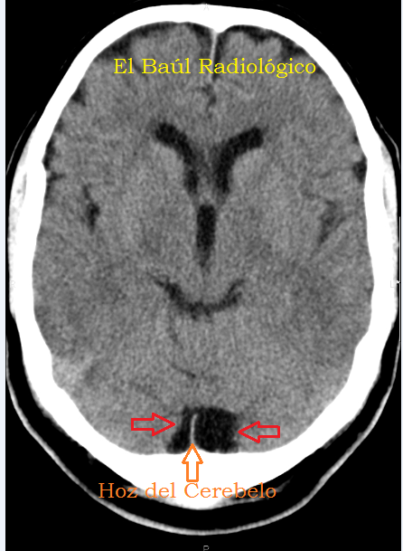 El Baúl Radiológico: ASPECTO DE LA CISTERNA MAGNA EN TOMOGRAFÍA ...