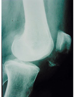 Un médecin du sport vous informe: fractures de la rotule