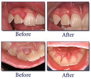 Tooth & Gums: Excision of Oral Lesions