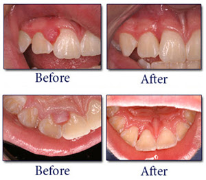 Tooth & Gums: Excision of Oral Lesions