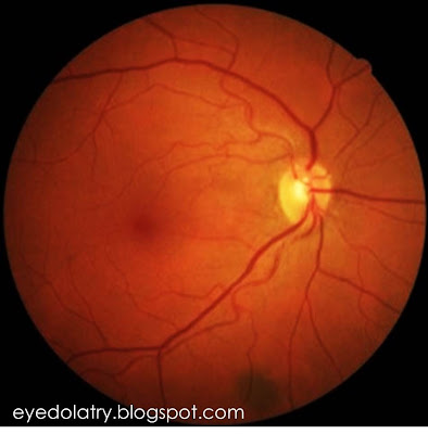 Diagnose My Retinal Photograph: Freckles Inside the Eye - Eyedolatry