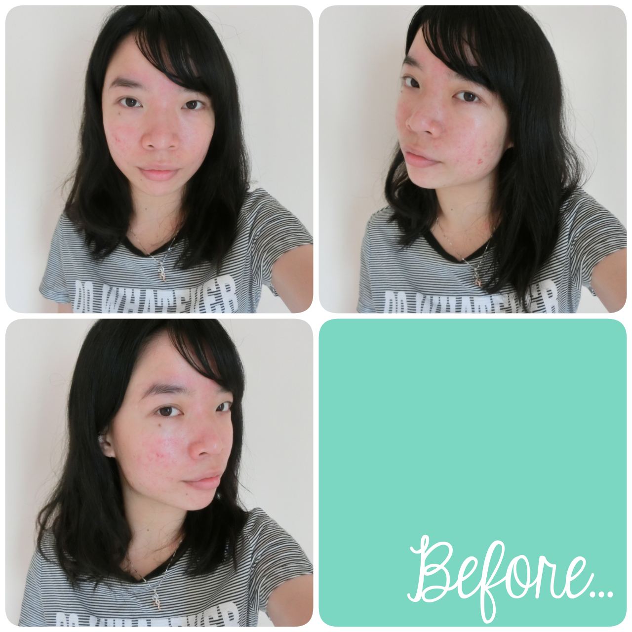 Laser Treatment at Ting's Skin Specialist | voguelyvivien