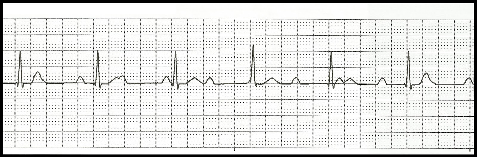 ECG Rhythm Strip Quiz 118